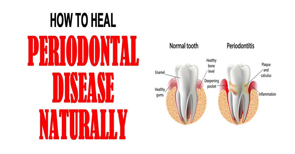 How to Heal Periodontal Disease Naturally